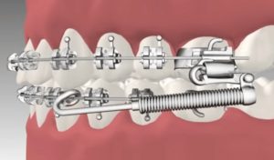 Forsus Orthodontic Appliances in Fort Worth TX - Perkins Orthodontics