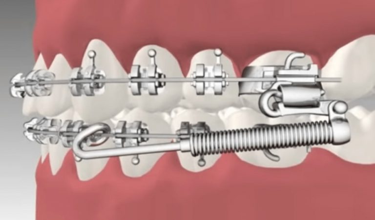 Forsus Orthodontic Appliances in Fort Worth TX - Perkins Orthodontics