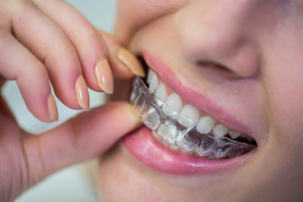 Why Retainers Are Just As Important As Braces